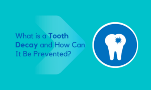 Understanding Tooth Decay: Causes and Prevention